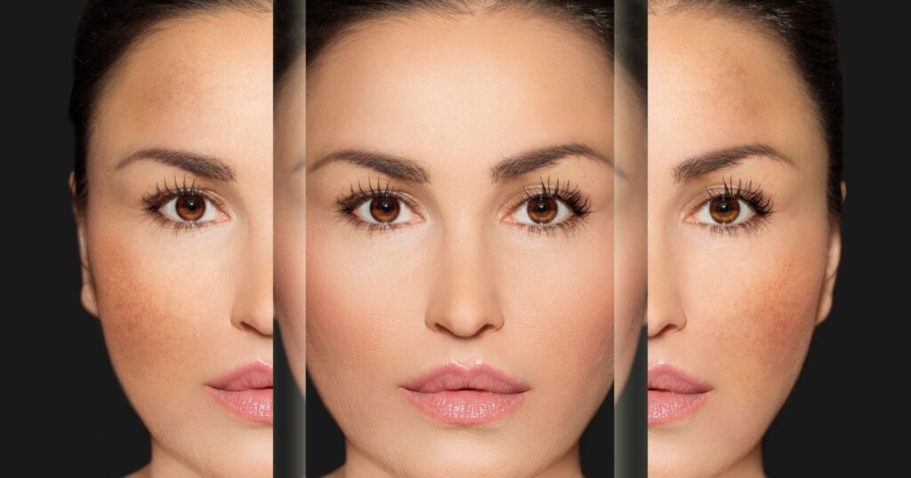 Melasma Treatment | Chicago Skin Clinic