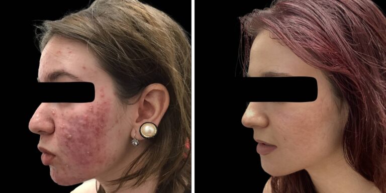 Acne Treatment | Chicago Skin Clinic